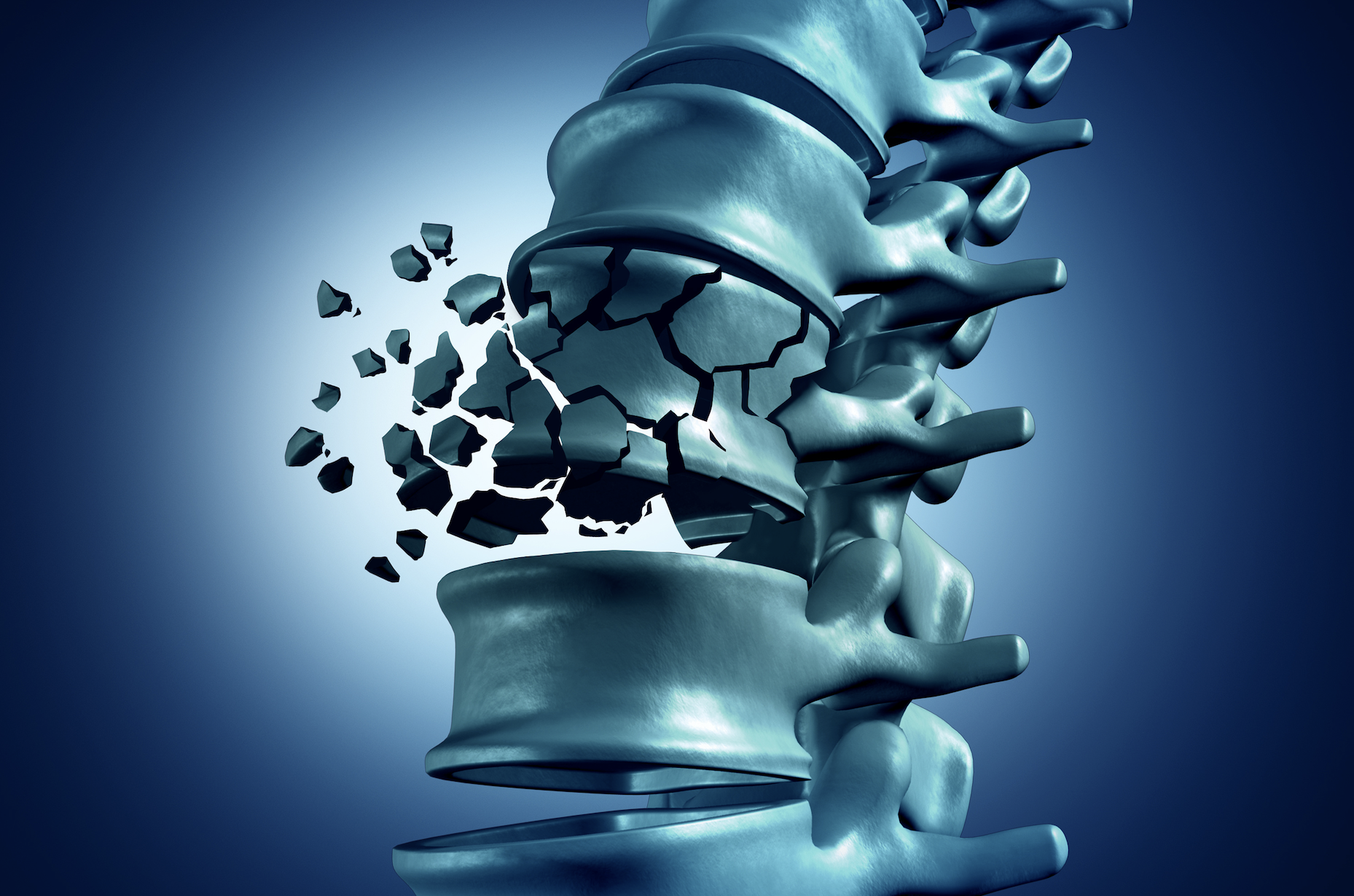 Cause of Back Pain: Vertebral Compression Fracture - Texas-Neuro Spine ...